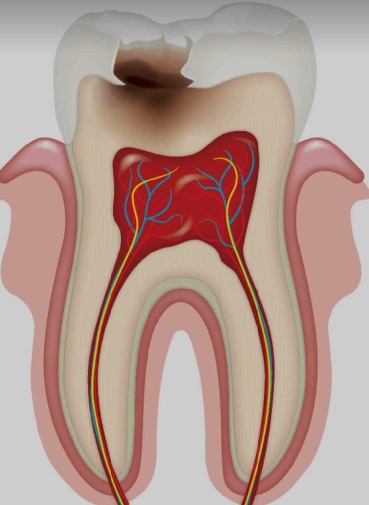 Caries treatment – Koronadent